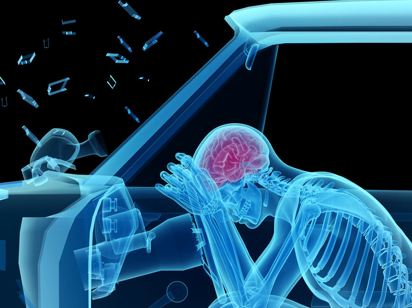 5 Brain Injuries From Auto Accidents and Your Legal Options - Sharpe ...